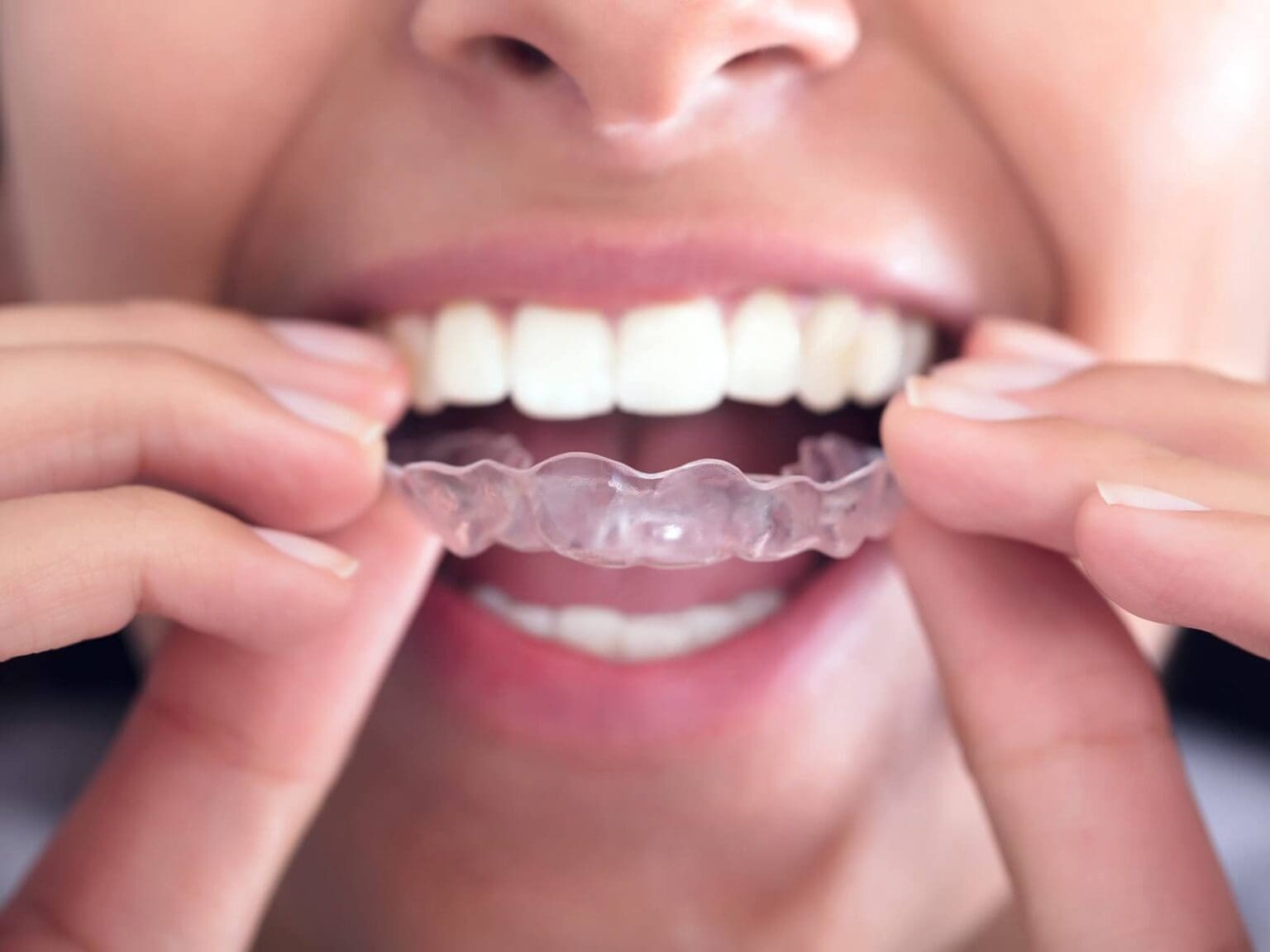 Can Invisalign Fix an Overbite? | Roeder Orthodontics